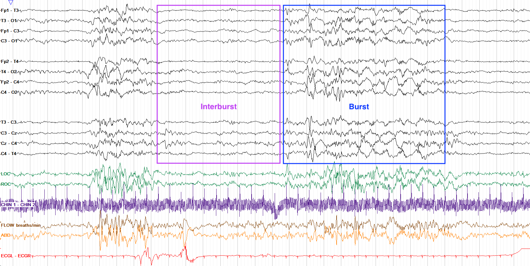 Normal Eeg Tracing